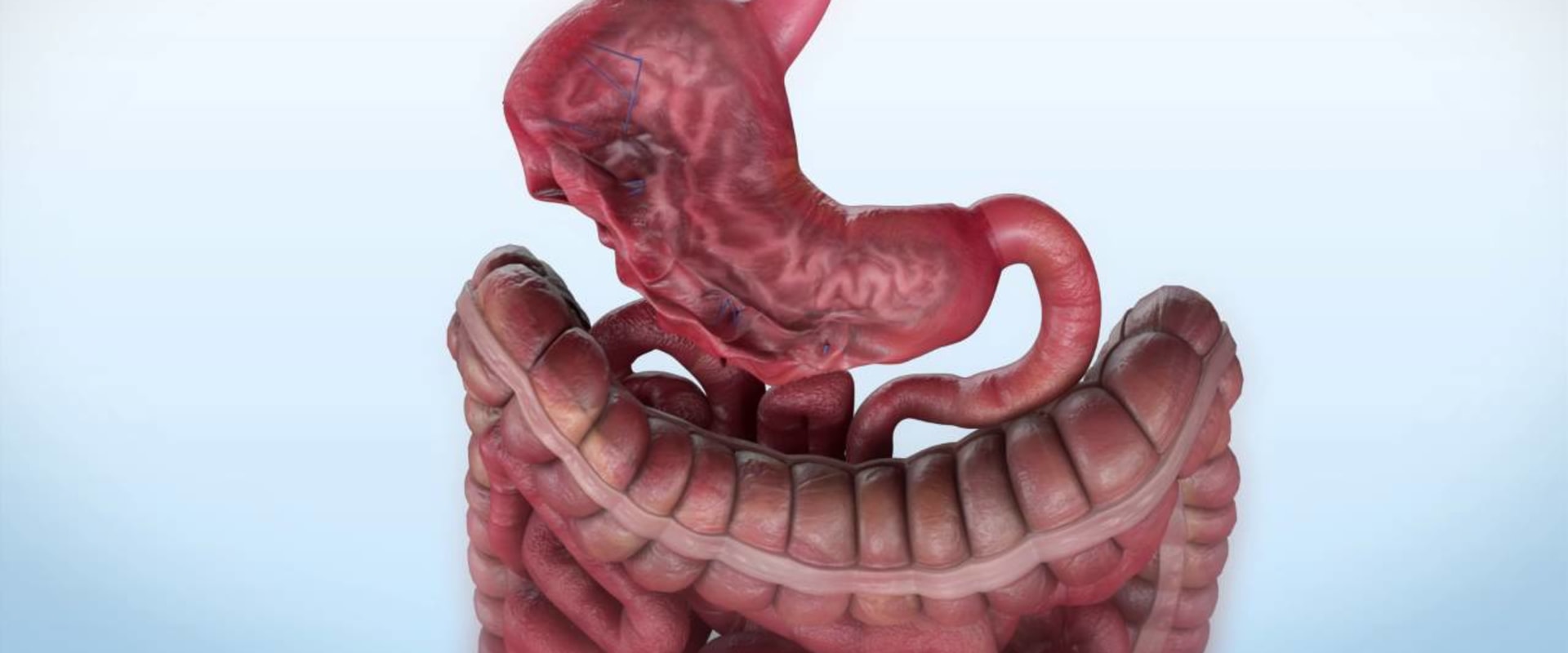 Understanding Endoscopic Sleeve Gastroplasty (ESG)